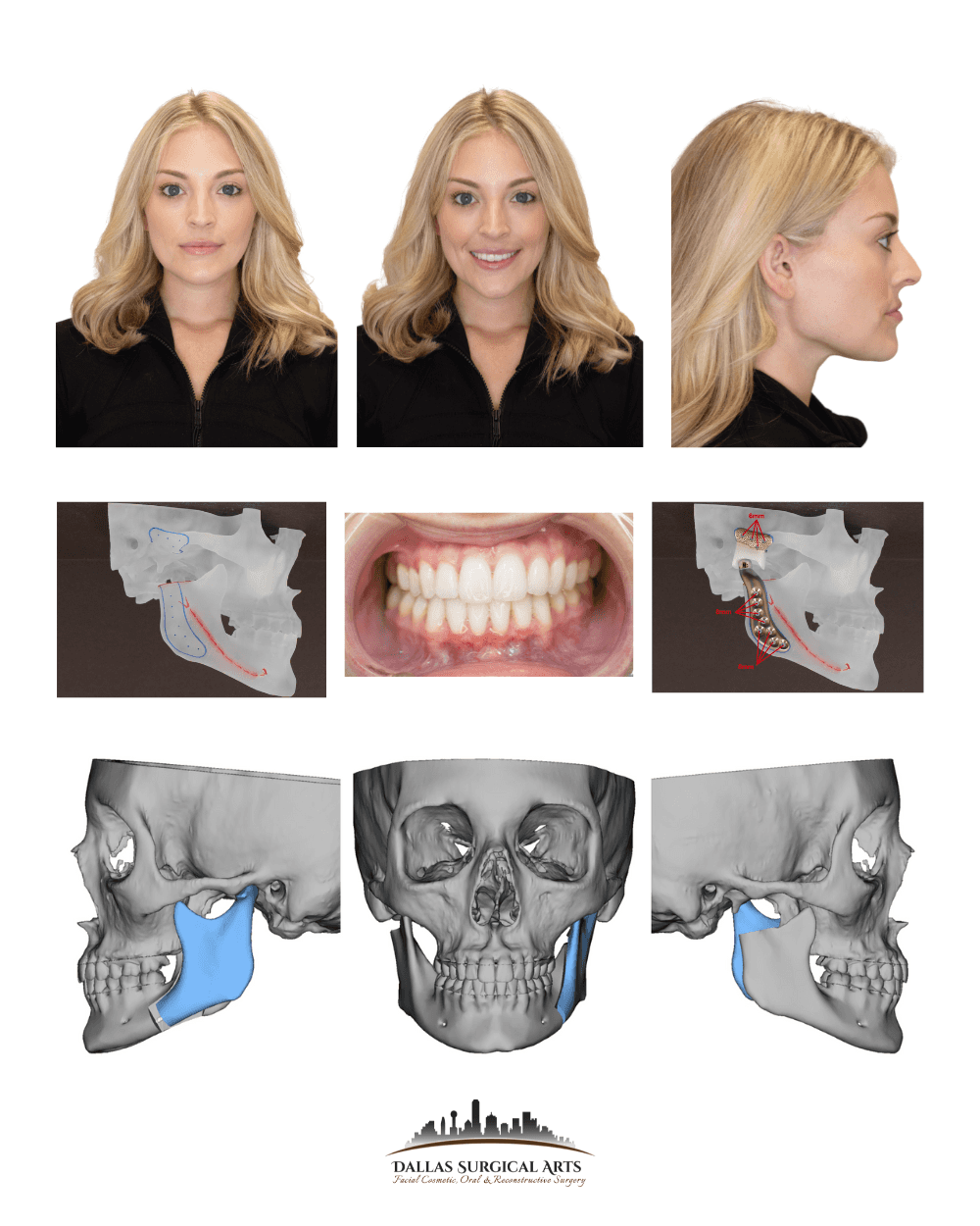 Jaw Repositioning (Orthognathic Surgery) | Dallas Surgical Arts